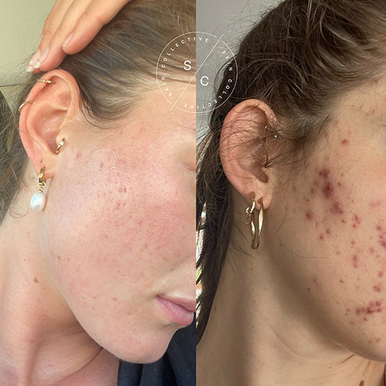 Acne Awareness - Breaking down the stigma around breakouts – Skin ...